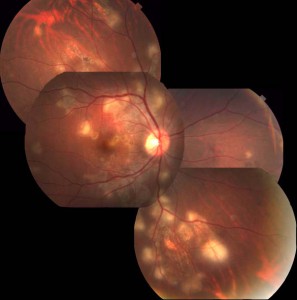 Serpiginous choroiditis and Tuberclulous serpiginouslike choroiditis ...